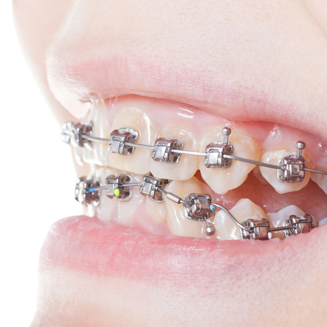 Precio Brackets Damon Ultima en Bogotá, tratamiento de ortodoncia de ...